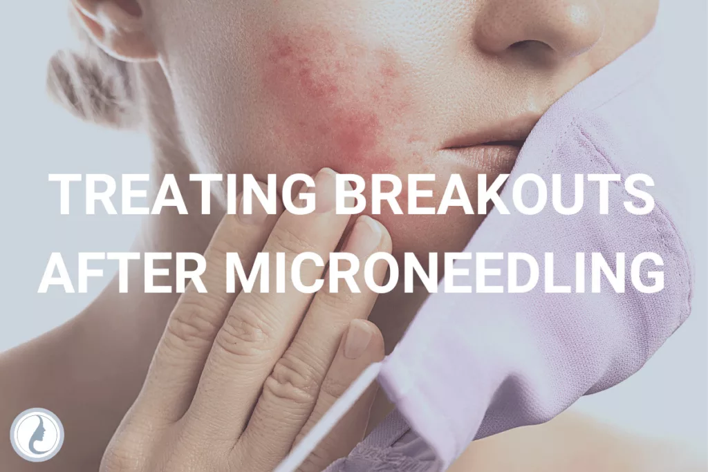 How To Treat Breakouts After Microneedling - Pro Needling